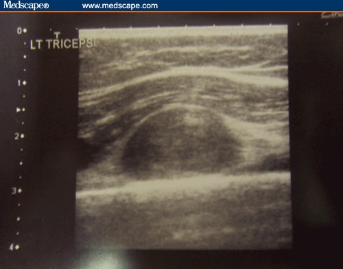 Muscular Metastasis, A Rare Presentation of Non-Small-Cell Lung Cancer