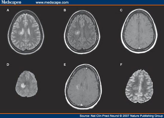 Balo's Concentric Sclerosis Presenting as a Stroke-like Syndrome