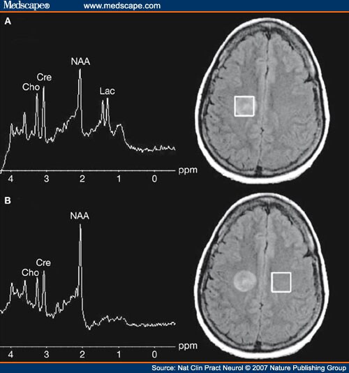 Balo's Concentric Sclerosis Presenting as a Stroke-like Syndrome