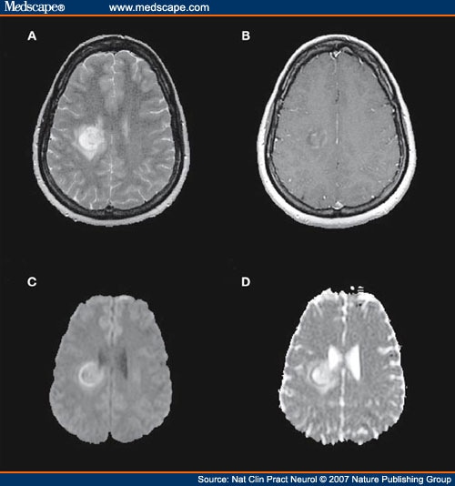 Balo's Concentric Sclerosis Presenting as a Stroke-like Syndrome