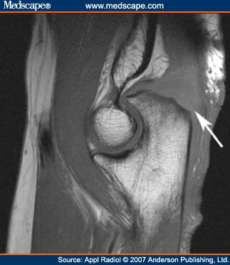 Triceps Tendon Tear
