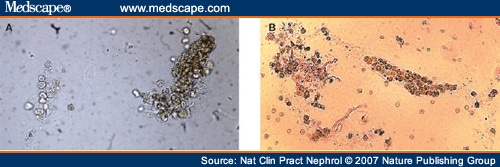 Four Cases of Nafcillin-Associated Acute Interstitial Nephritis
