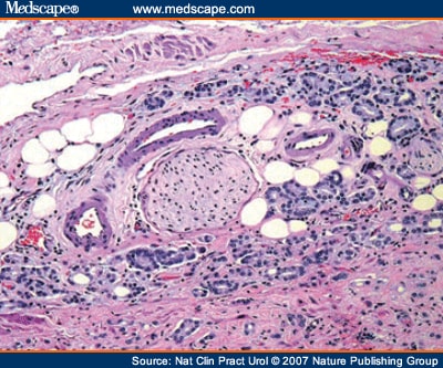 Radical Prostatectomy for Clinical T3 Disease