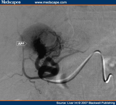 Pyothorax Without Fistula