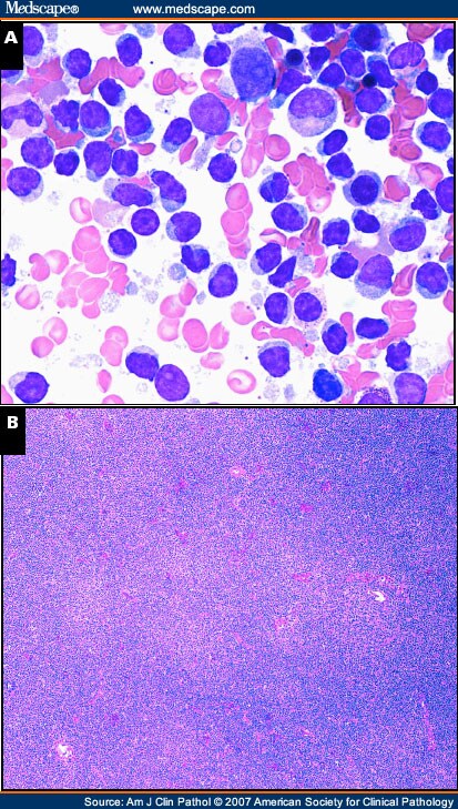 Chronic Lymphocytic Leukemia FISH Panel: Impact on Diagnosis