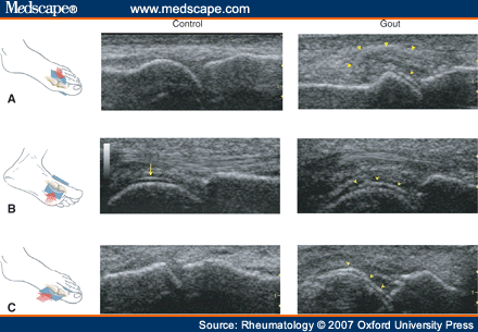 Diagnosis of gout by ultrasound