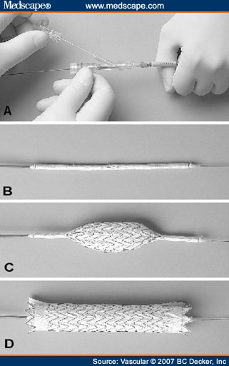 Endovascular Repair of Thoracic Aortic Disease - Page 2