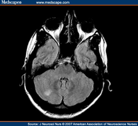 Acute Disseminated Encephalomyelitis