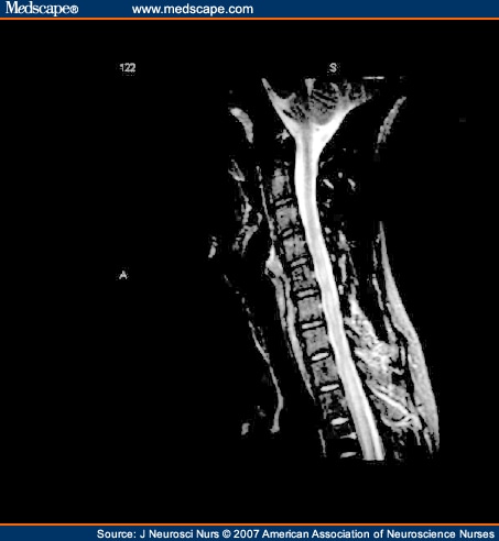 Acute Disseminated Encephalomyelitis