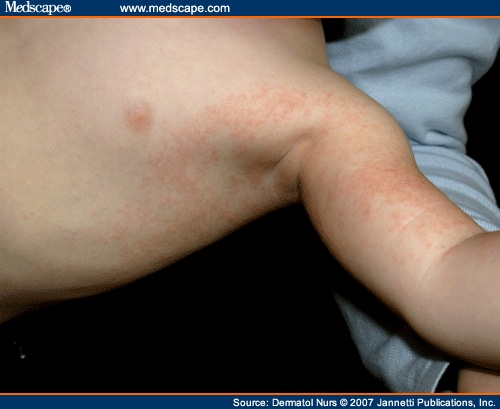 Left-Sided Eruption on a Child: Case Study