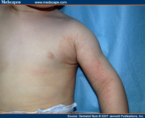 Left-Sided Eruption on a Child: Case Study