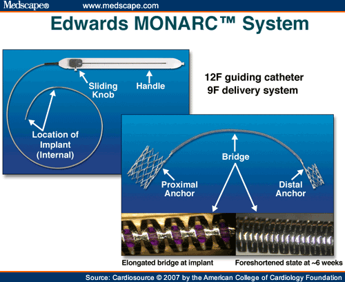 Percutaneous Repair of Mitral Regurgitation Using Coronary Sinus Devices