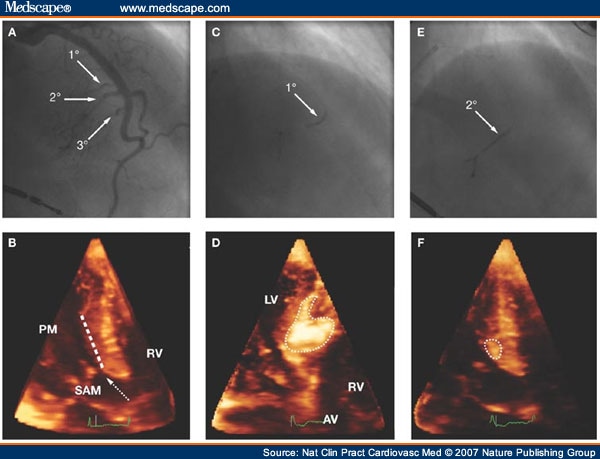 Alcohol Septal Ablation vs. Surgical Myectomy: Patient With Obstructive ...