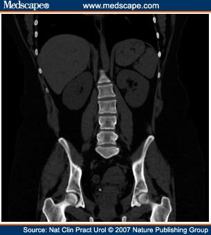 Urolithiasis: The Influence of Stone Size on Management