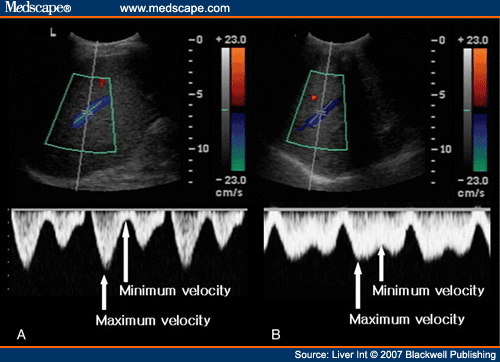 Damping Index of Doppler Hepatic Vein Waveform - Portal Hypertension