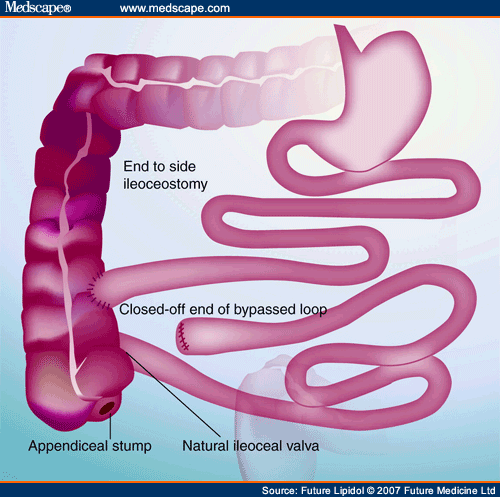 Surgical Intervention for the Treatment of Morbid Obesity and Dyslipidemias