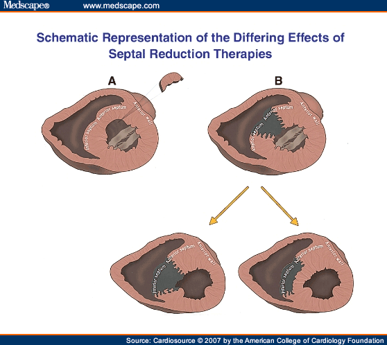 Alcohol Septal Ablation: Follow-Up at 10 Years - Page 2