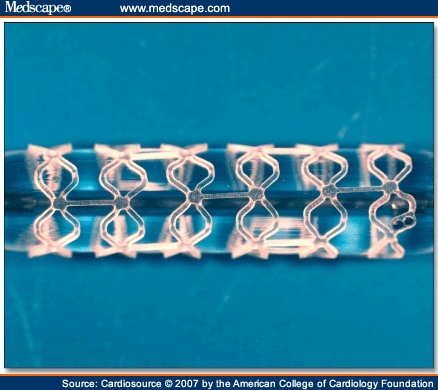 Angiographic and IVUS Results From First-in-Man Bioabsorbable Stent ...