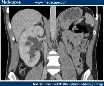 Laparoscopic Pyeloplasty in a Solitary Kidney - Page 2