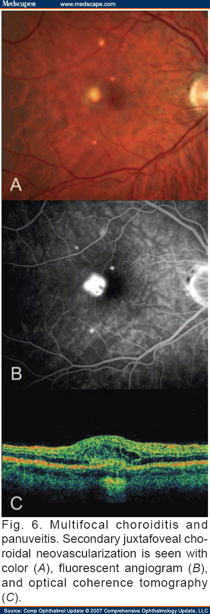 The White Dot Syndromes - Page 5