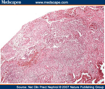 Isolated Skin Ulcers due to Mycobacterium Tuberculosis in a Renal ...