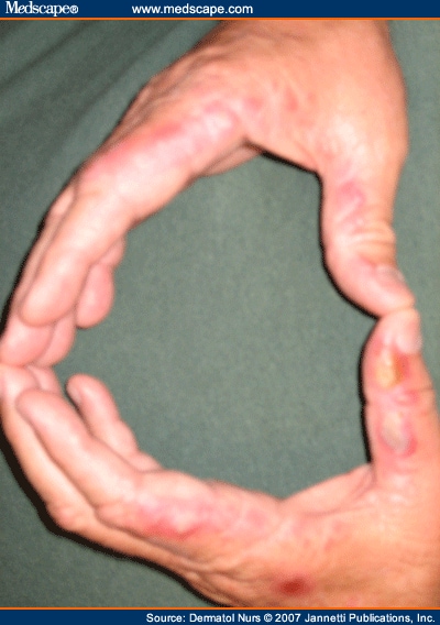 Phytophotodermatitis