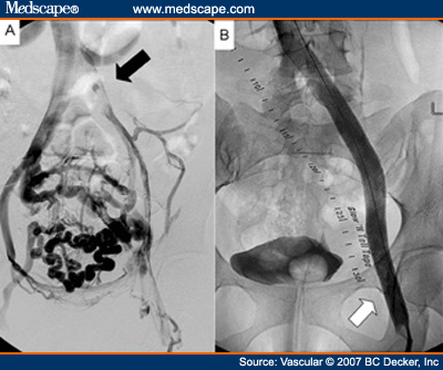 Chronic Venous Obstruction and Iliac Stenting - Page 2