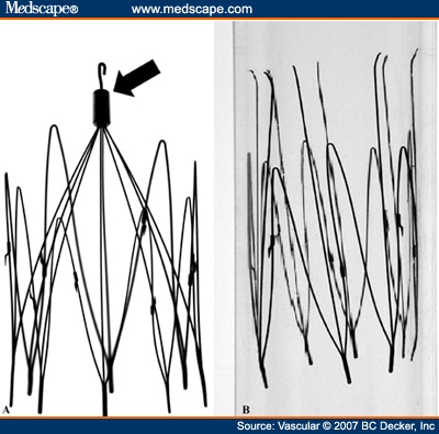 Optional Vena Cava Filters: What, Why, and When