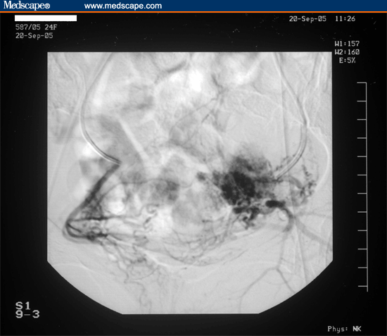Failed Angiographic Embolization in Uterine Arteriovenous Malformation ...