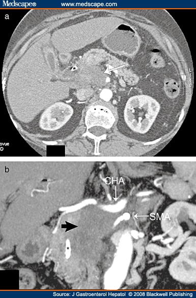 Radiology of Pancreatic Adenocarcinoma: Current Status of Imaging - Page 2