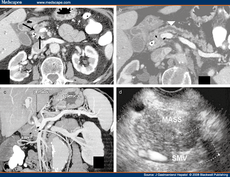 Radiology of Pancreatic Adenocarcinoma: Current Status of Imaging - Page 5