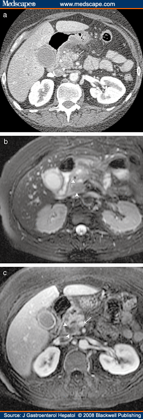 Radiology of Pancreatic Adenocarcinoma: Current Status of Imaging - Page 5