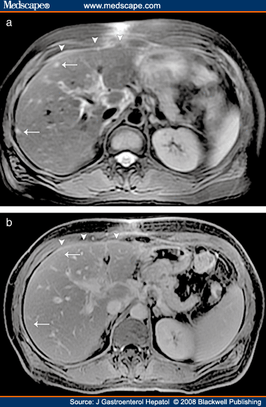 Radiology of Pancreatic Adenocarcinoma: Current Status of Imaging - Page 5