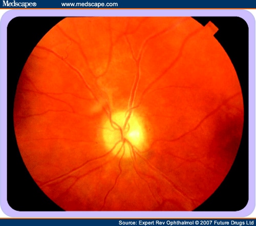 Update on Ocular Behcet's Disease - Page 6