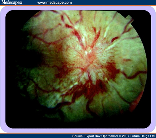 Update on Ocular Behcet's Disease - Page 6