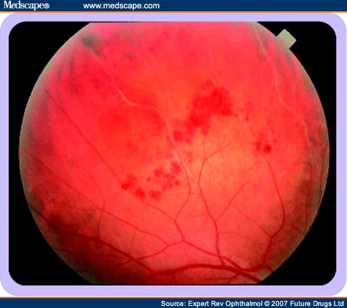 Update on Ocular Behcet's Disease - Page 6