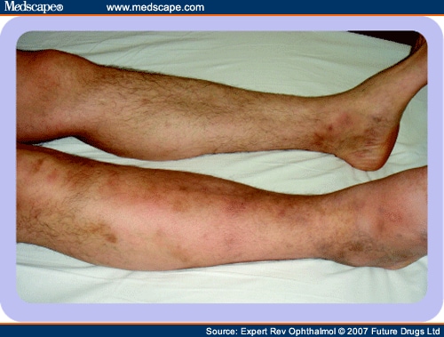 Update on Ocular Behcet's Disease - Page 5