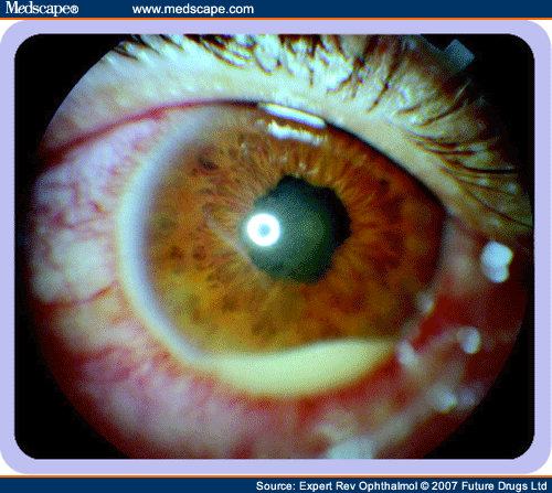 Update on Ocular Behcet's Disease - Page 6