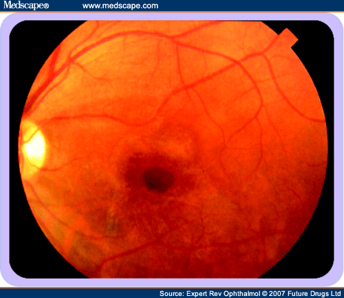 Update on Ocular Behcet's Disease - Page 6