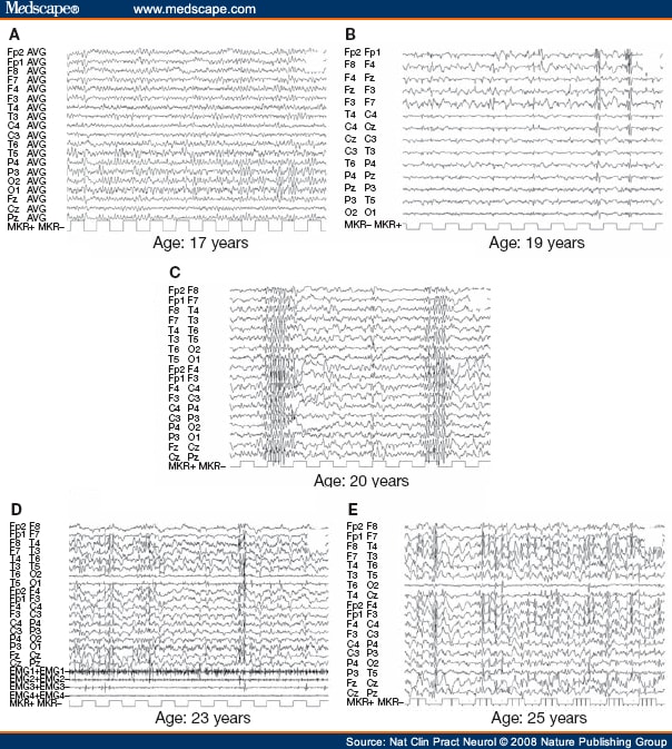 Typical Progression of Myoclonic Epilepsy of the Lafora Type: A Case ...