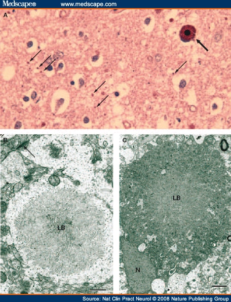 Typical Progression of Myoclonic Epilepsy of the Lafora Type: A Case ...