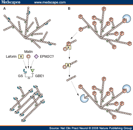 Typical Progression of Myoclonic Epilepsy of the Lafora Type: A Case ...