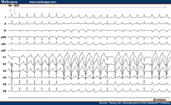 Atrial Overdrive Pacing Inducing QRS Complexes of Varying Duration