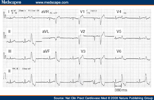 A Case of Vagally Mediated Idiopathic Ventricular Fibrillation - Page 2