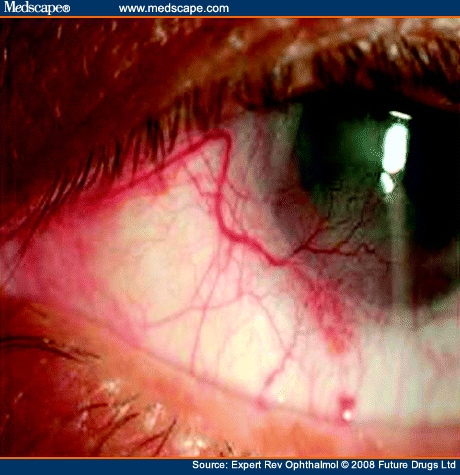 Diagnosis and Management of Malignant Tumors of the Eye - Page 3