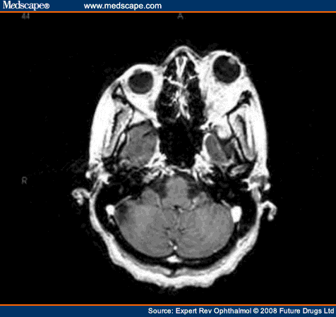 Diagnosis and Management of Malignant Tumors of the Eye - Page 4