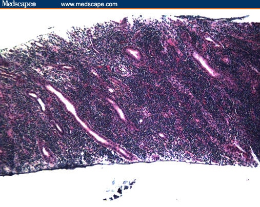 Acute Renal Failure Secondary to Chronic Lymphocytic Leukemia