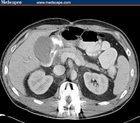 Traumatic Biliary Stricture