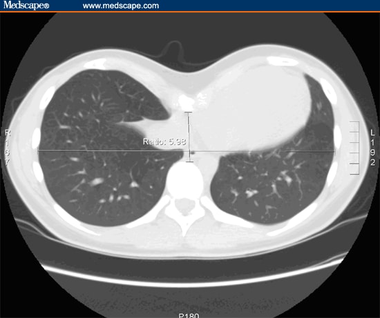 Cardiopulmonary Manifestations of Pectus Excavatum - Page 2