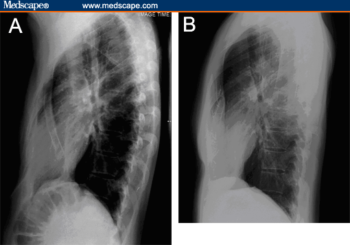 Cardiopulmonary Manifestations of Pectus Excavatum - Page 4